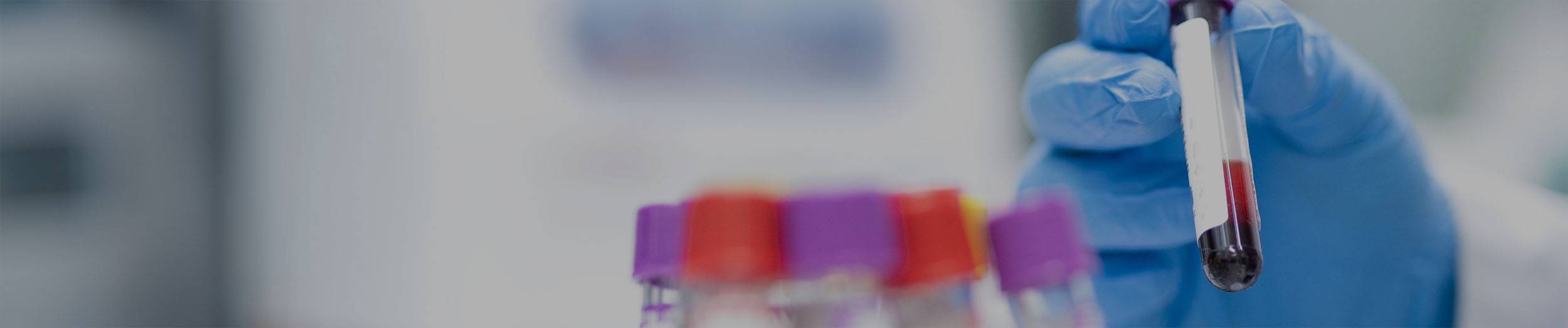 Leucemia linfática crónica (LLC): Síntomas, diagnóstico y tratamiento ...